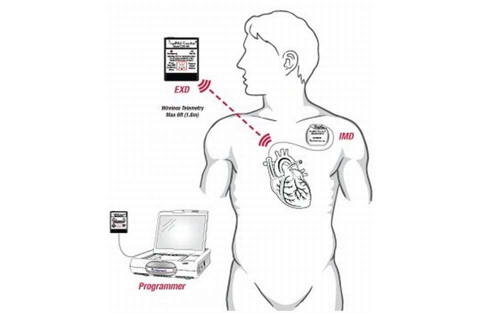 AngelMed Guardian System previne os ataques cardíacos