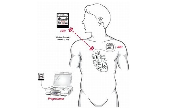 AngelMed Guardian System previne os ataques cardíacos